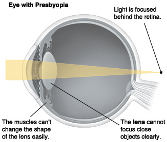 What Is Presbyopia?