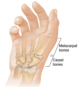 Understanding Carpometacarpal Osteoarthritis